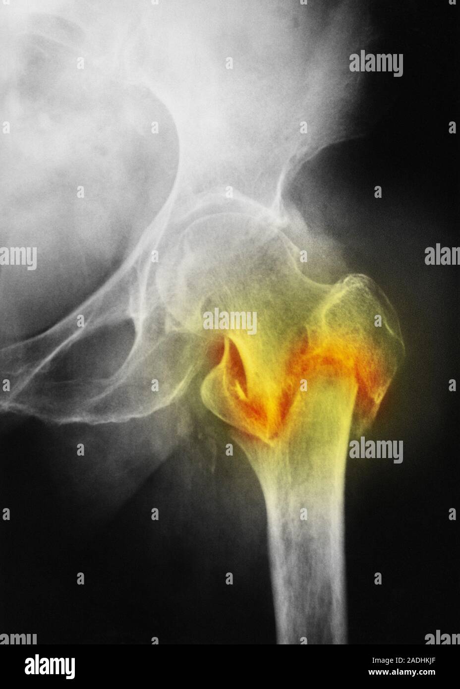 Osteoporosis fracture. Coloured X-ray of the hip of an elderly woman ...
