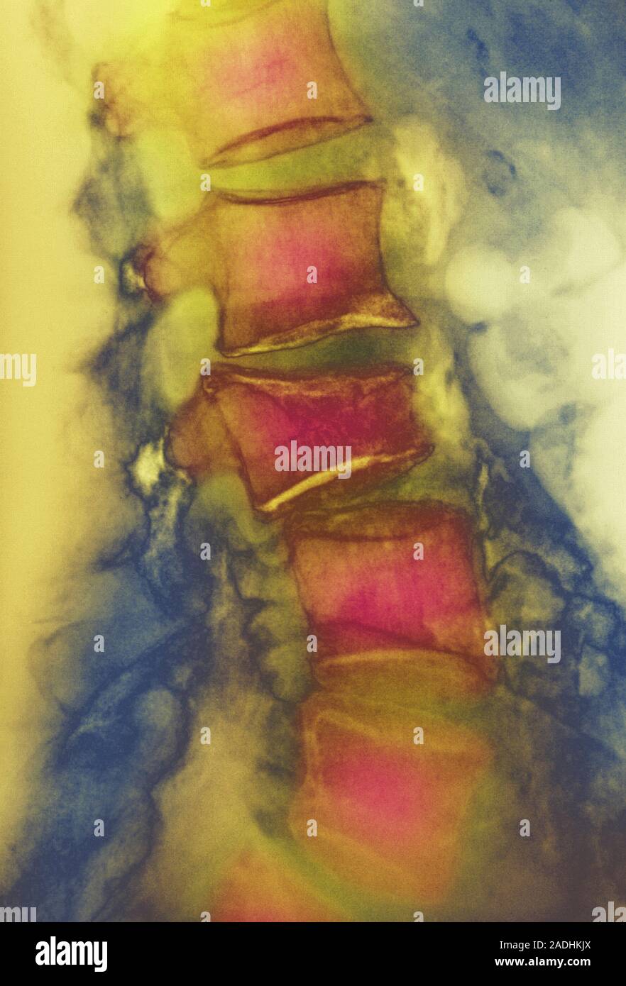 Osteoporosis. Coloured X-ray of a side view of the lumbar (lower) spine ...