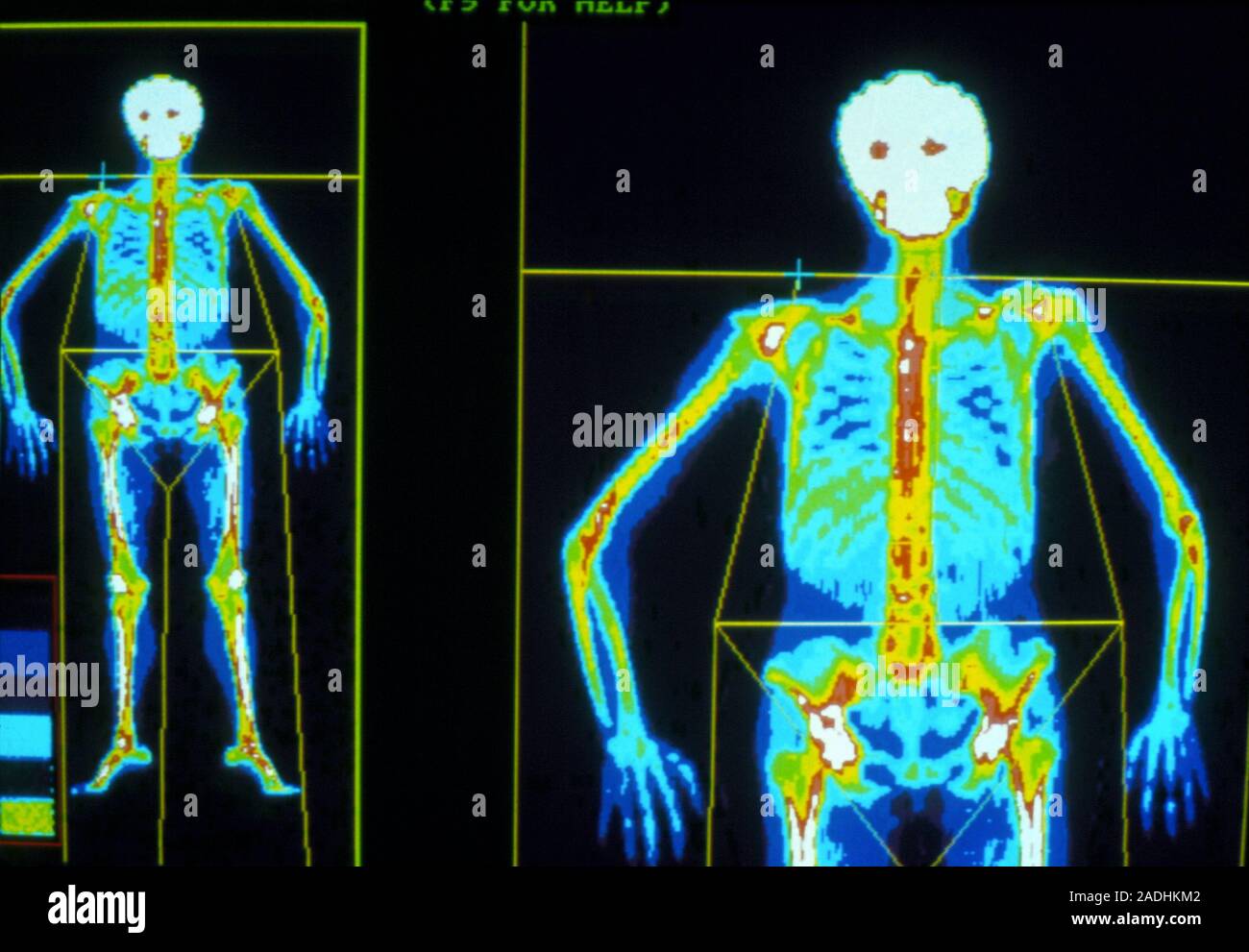 Osteoporosis. Coloured bone densitometry scan of a patient suffering ...