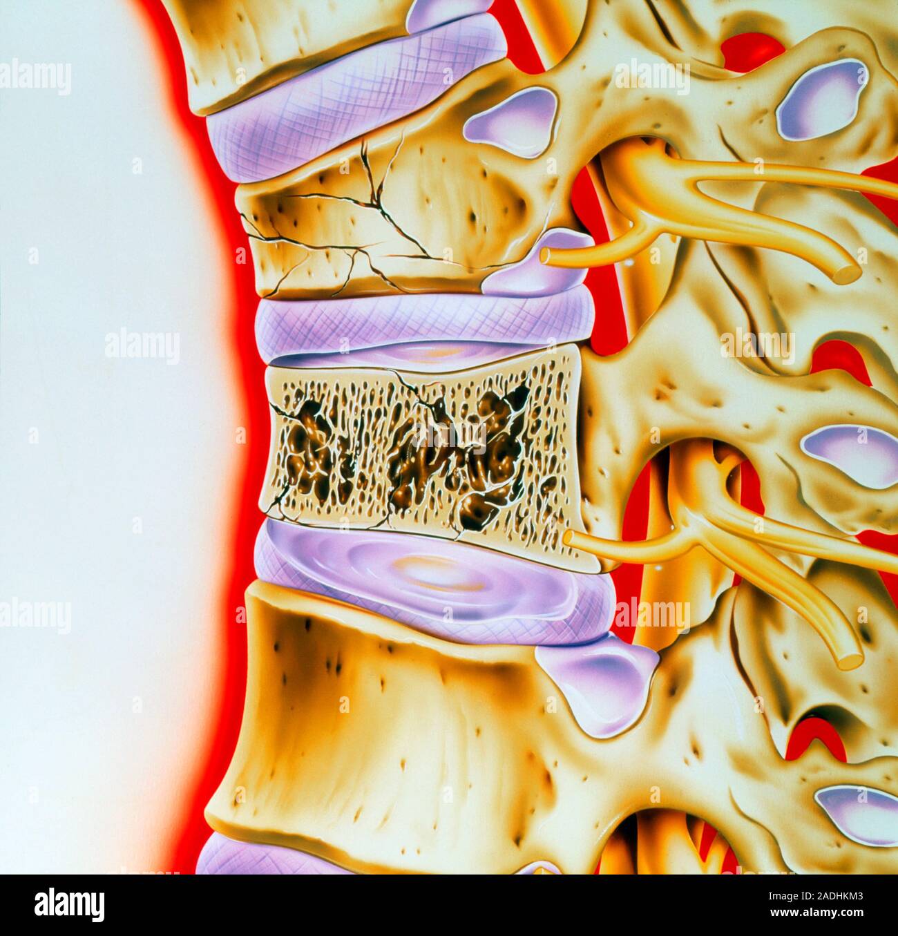 Osteoporosis. Artwork of a spine with fractured vertebrae due to ...