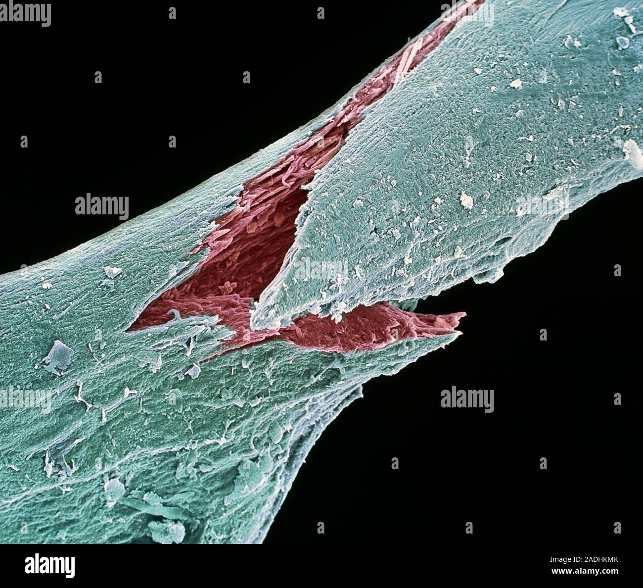 Osteoporotic bone. Coloured scanning electron micrograph (SEM) of ...