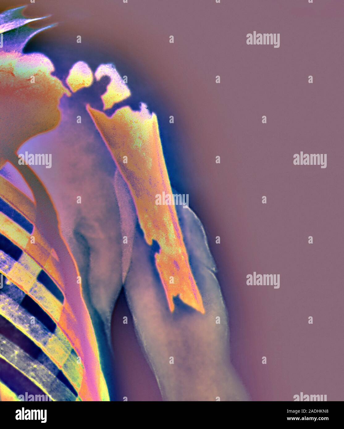 Bone infection. Coloured X-ray of a child's upper arm bone (humerus ...