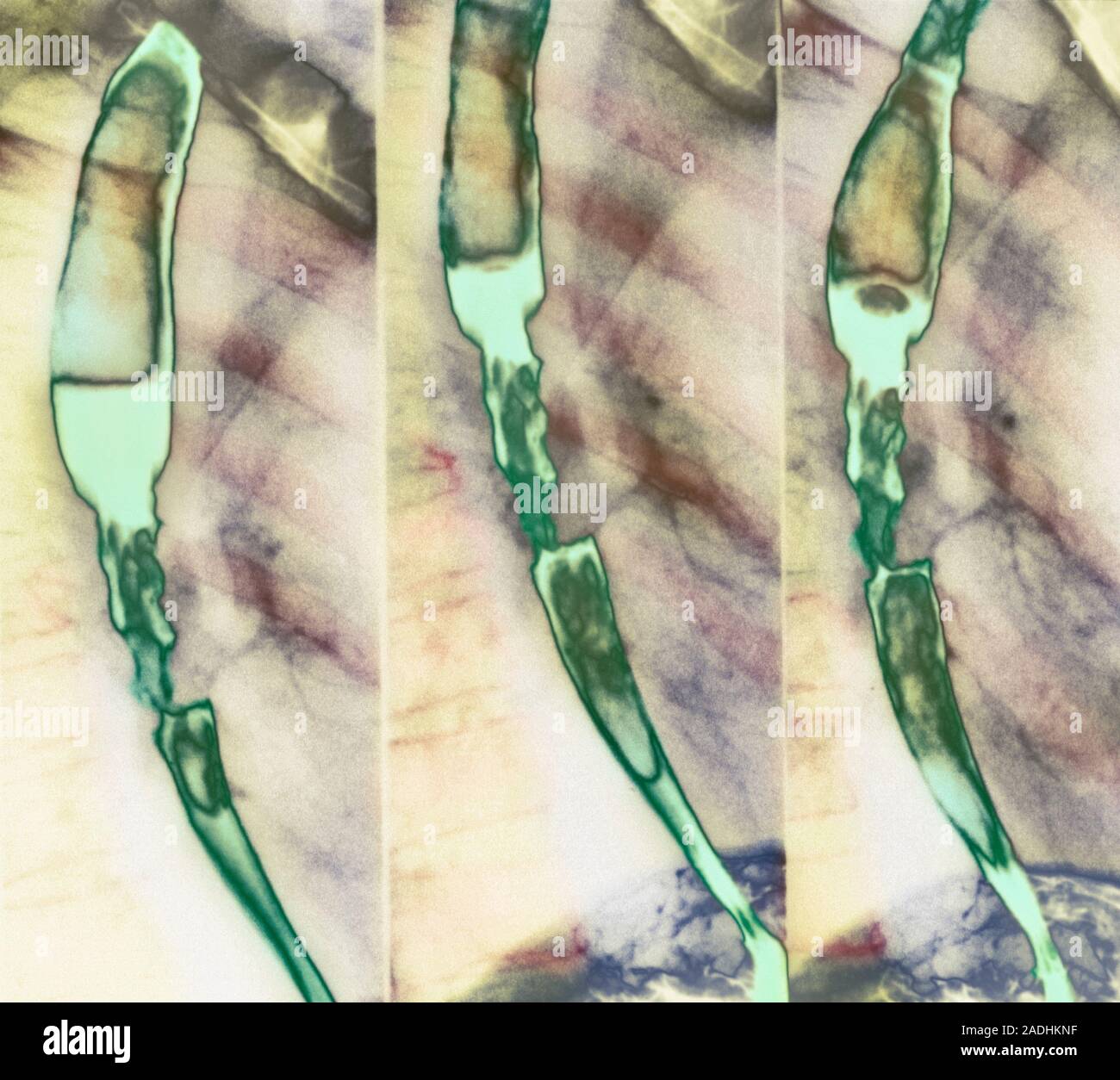 Constricted oesophagus. Coloured X-ray of a substance (green) passing ...