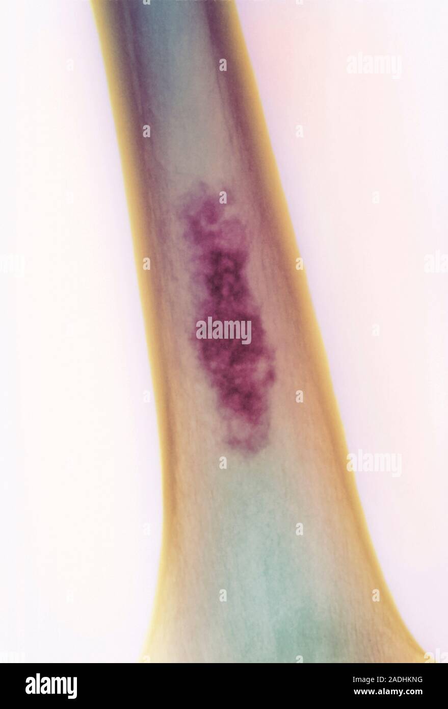Bone death. Coloured X-ray of the shaft of a human long bone showing ...