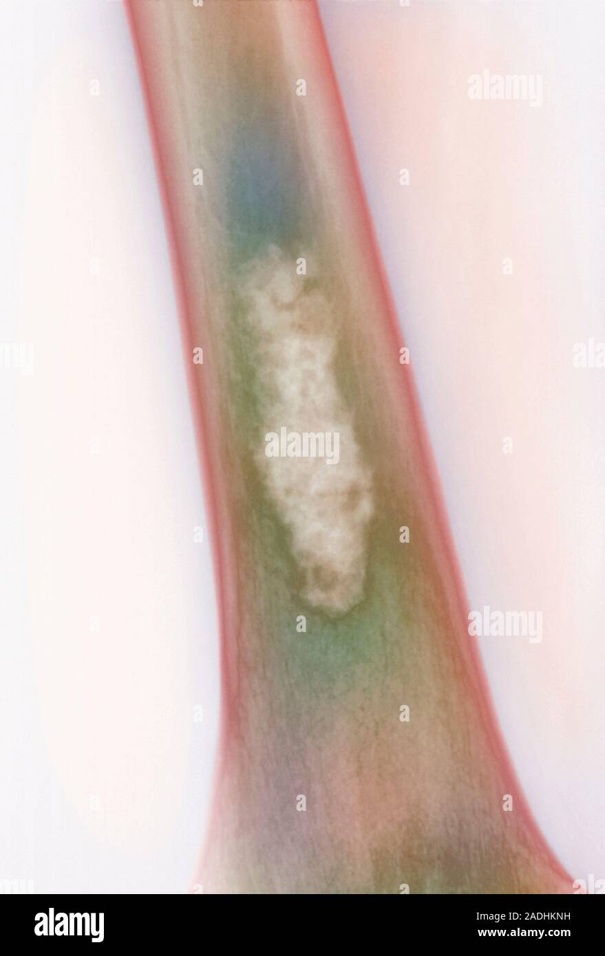 Bone death. Coloured X-ray of the shaft of a human long bone showing ...
