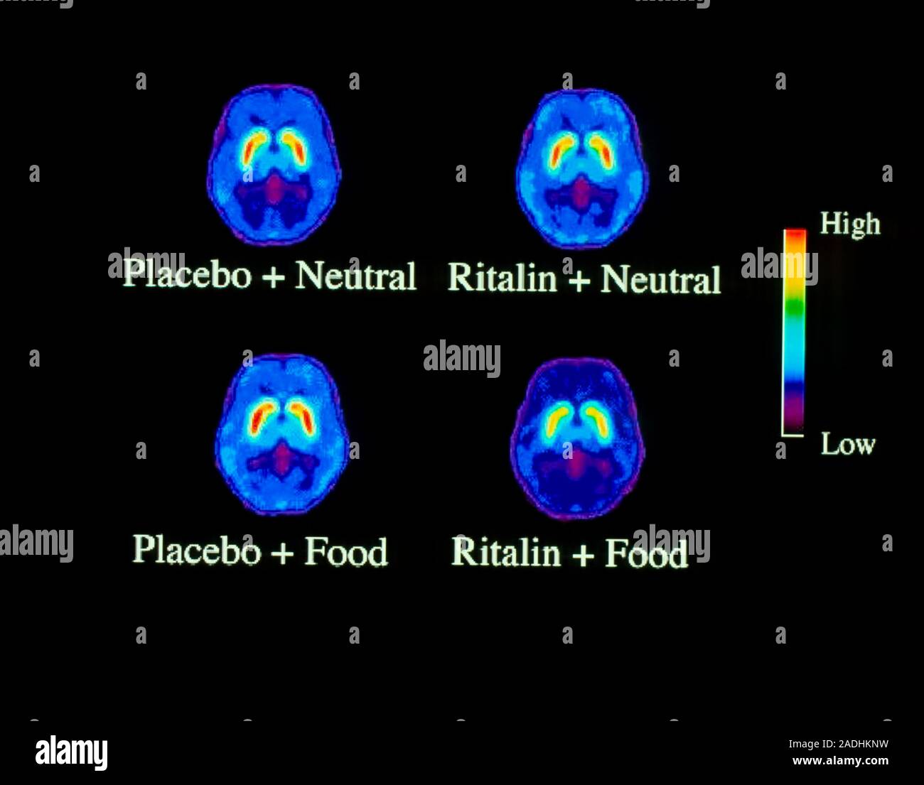 Food addiction brain research. Positron emission tomography (PET) scans ...