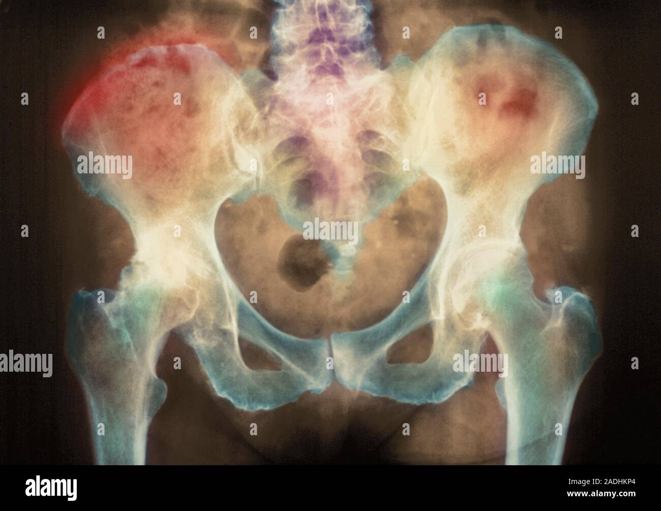 Bone death. Coloured X-ray of the pelvic girdle of a patient suffering ...