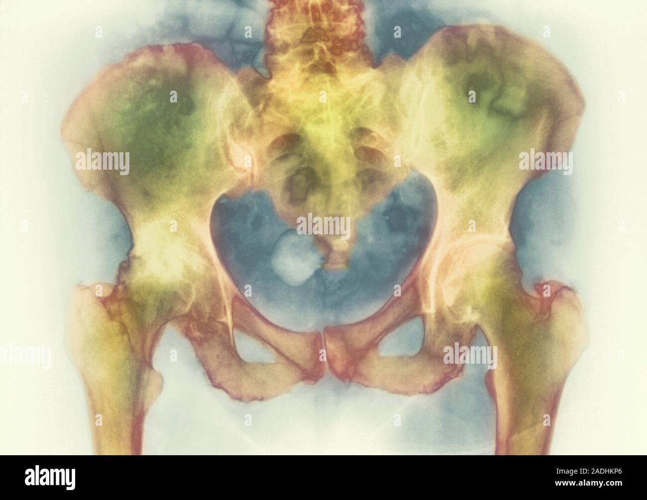 Bone death. Coloured X-ray of the pelvic girdle of a patient suffering ...