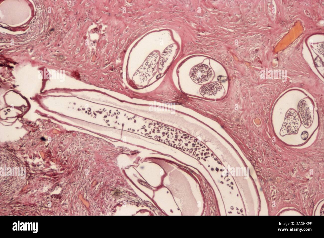 Onchocerca volvulus parasitic worms. Light micrograph of a section ...