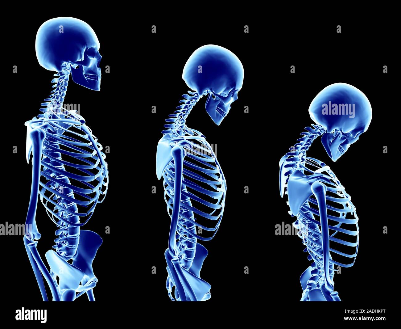 Osteoporosis. Computer artwork of a human female skeleton degenerating ...