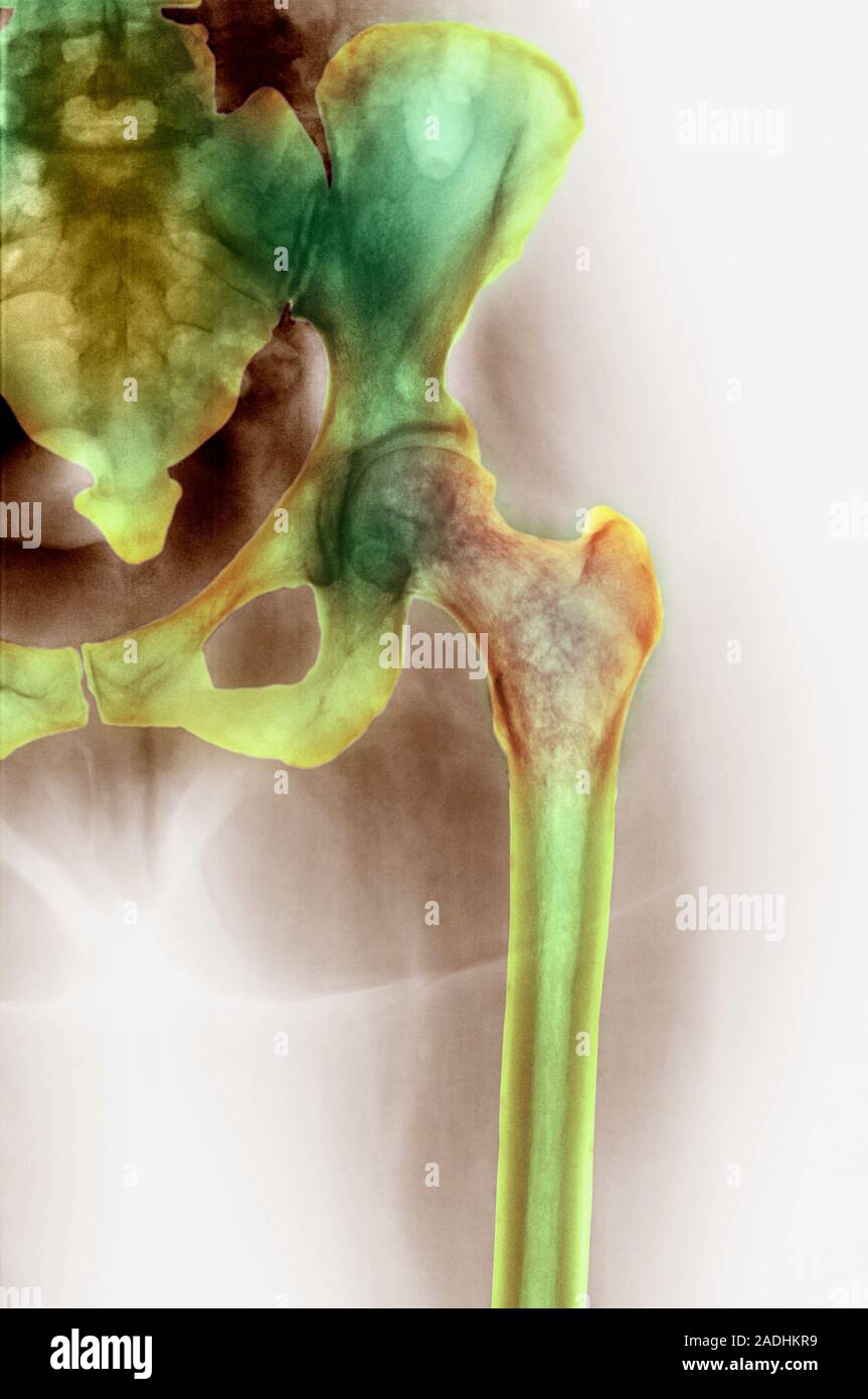 Osteoporosis. Coloured X-ray of the hip of a 43 year old woman showing ...