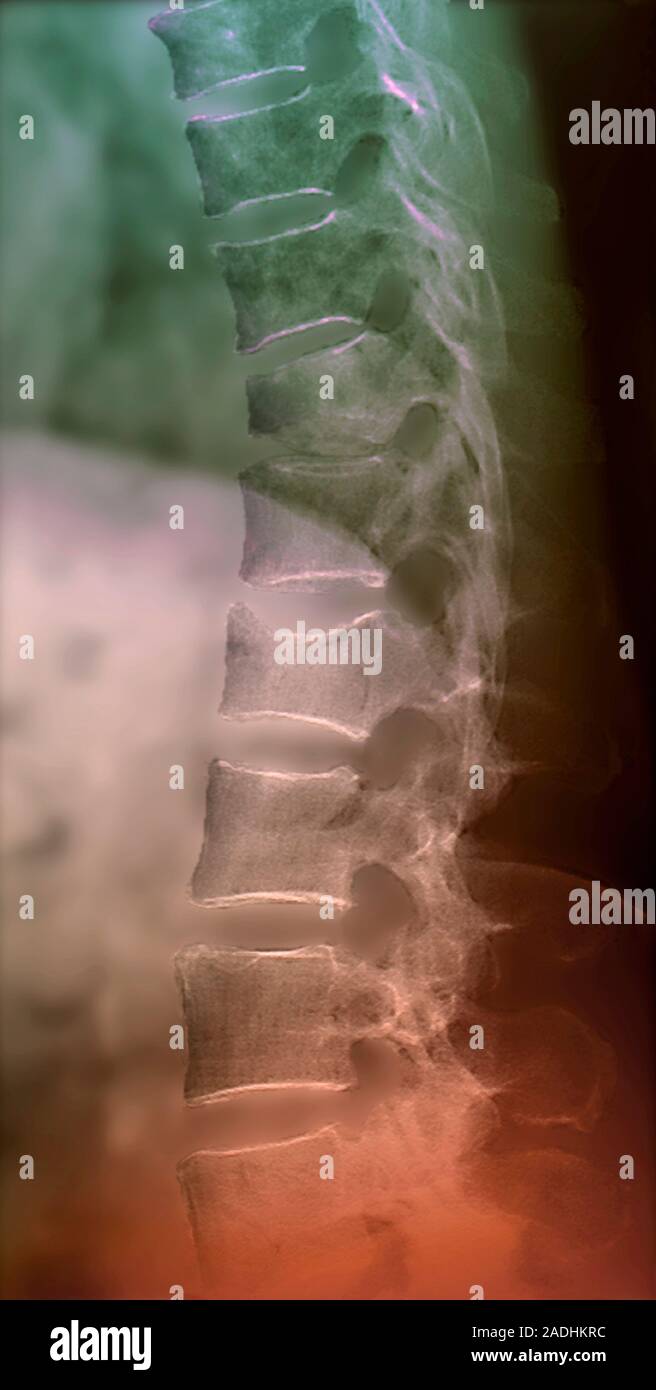 Spinal osteoporosis. Coloured X-ray of a side view of the dorso-lumbar ...