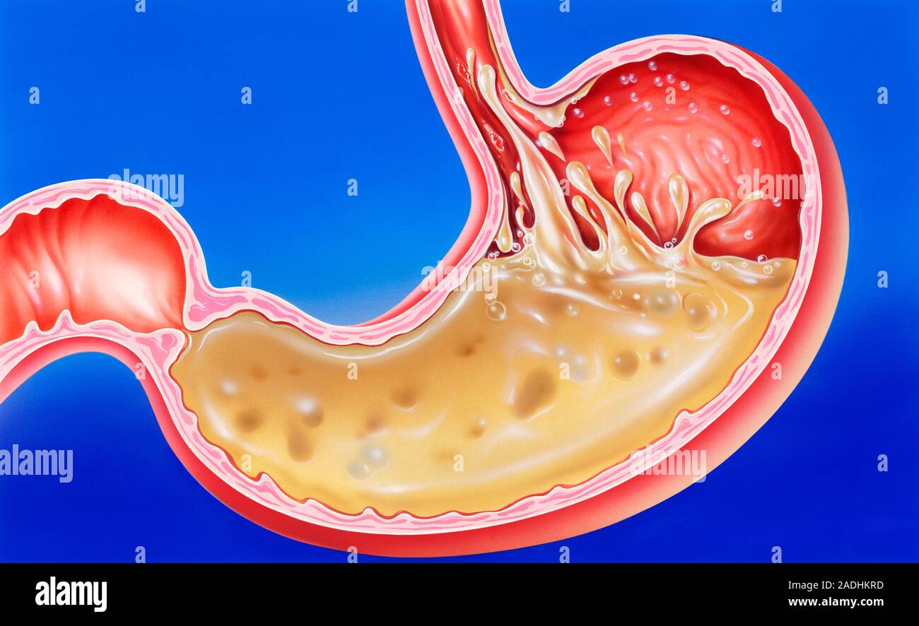 Gastric acid reflux. Artwork of the human stomach depicting gastro ...