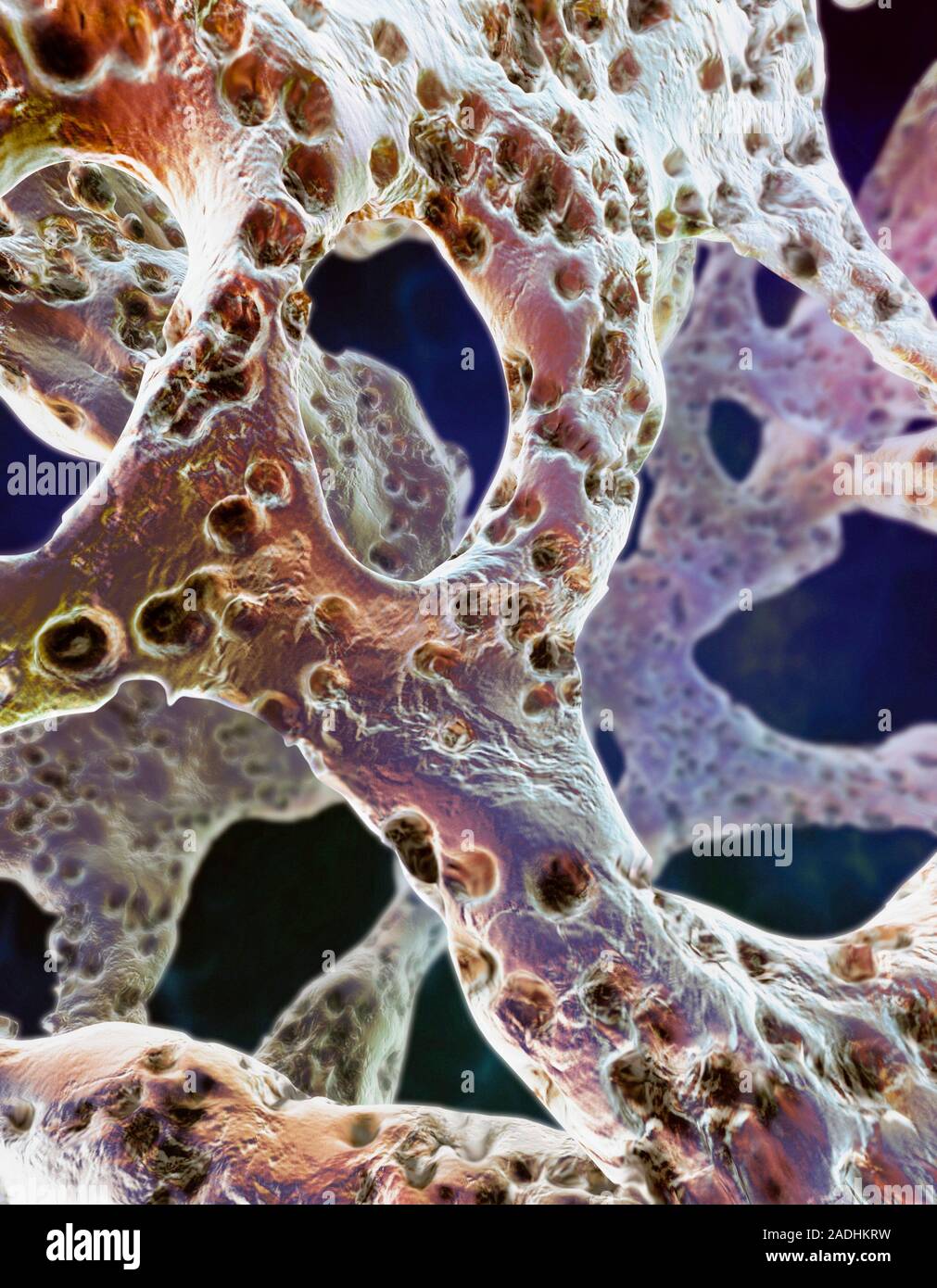 Osteoporosis. Computer artwork of osteoporotic bone. Osteoporosis ...
