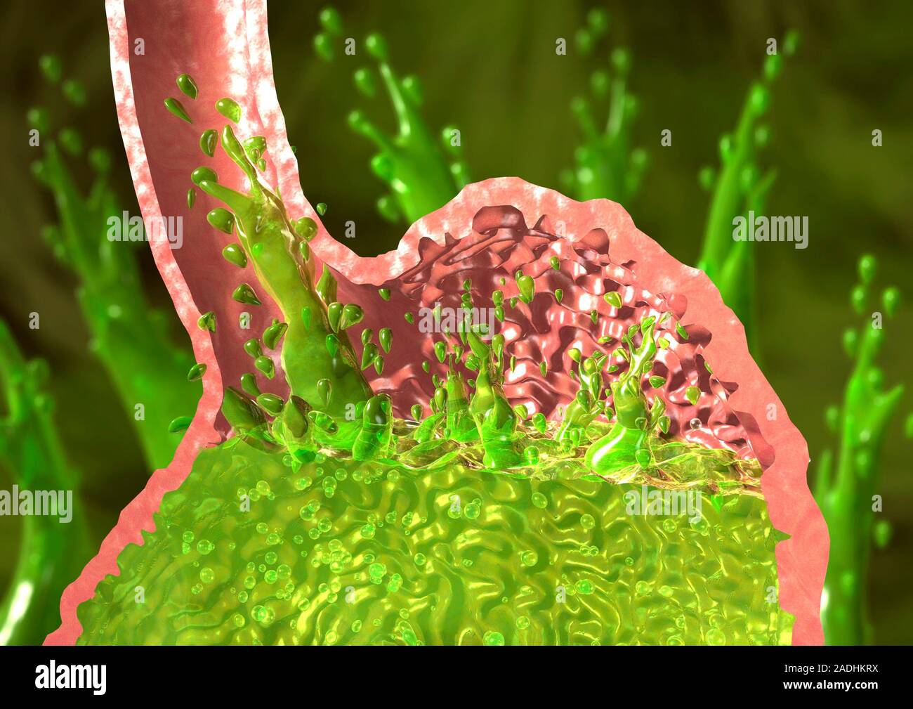 Heartburn. Computer artwork showing stomach acid (green) erupting up ...