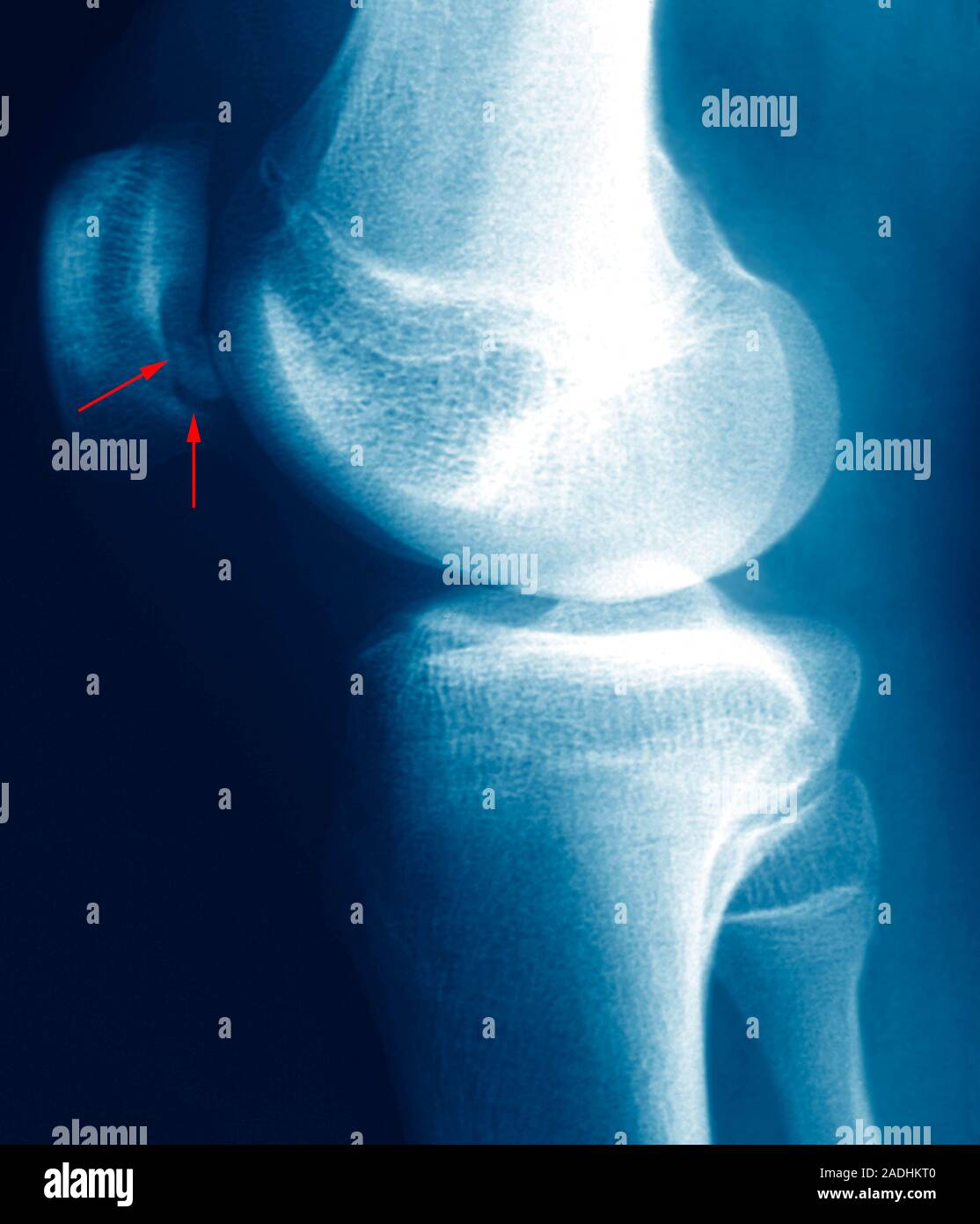Knee diseases. X-ray of an eighteen year old patient with ...