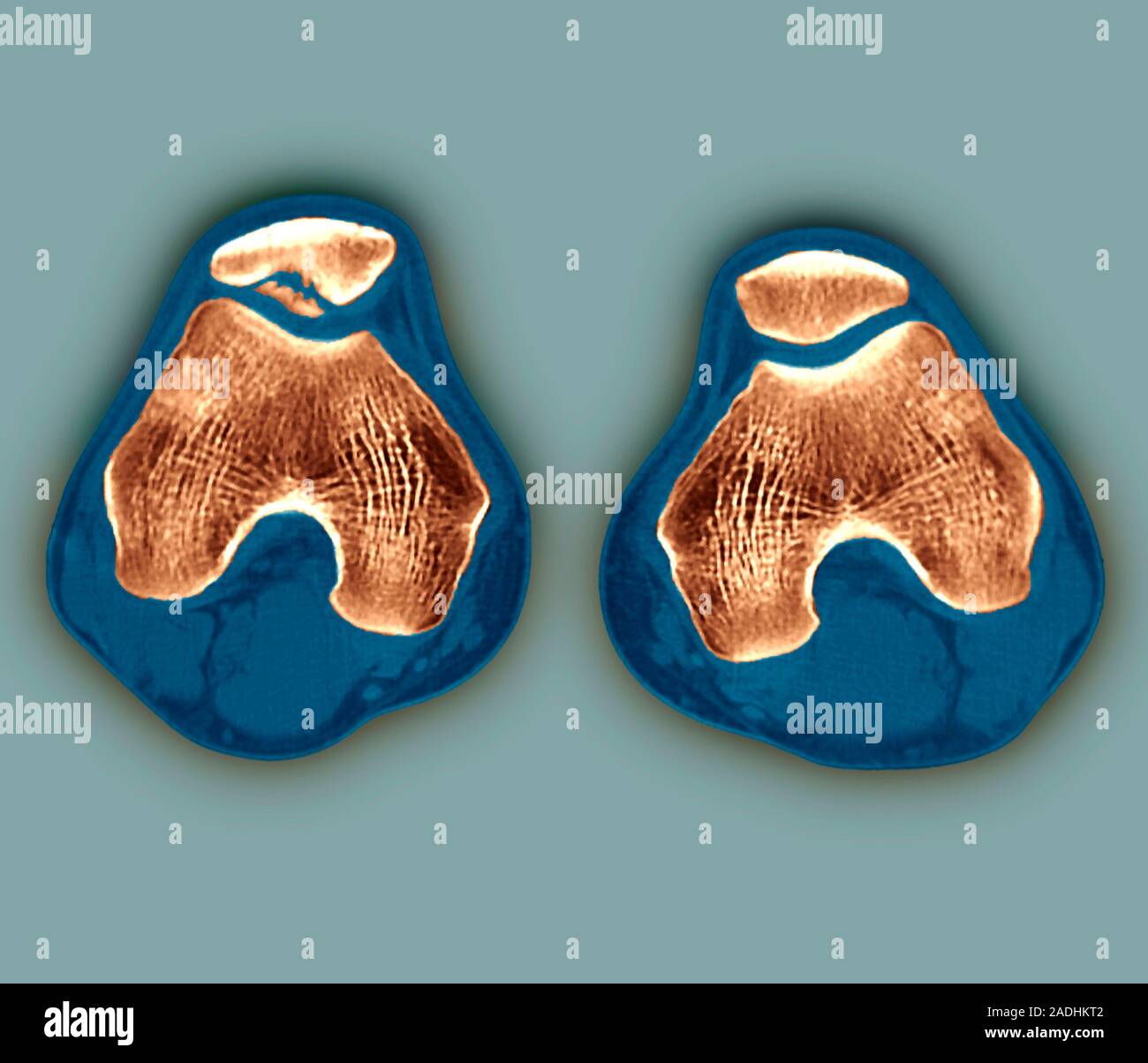Knee disease. Coloured computed tomography (CT) scan of an eighteen ...