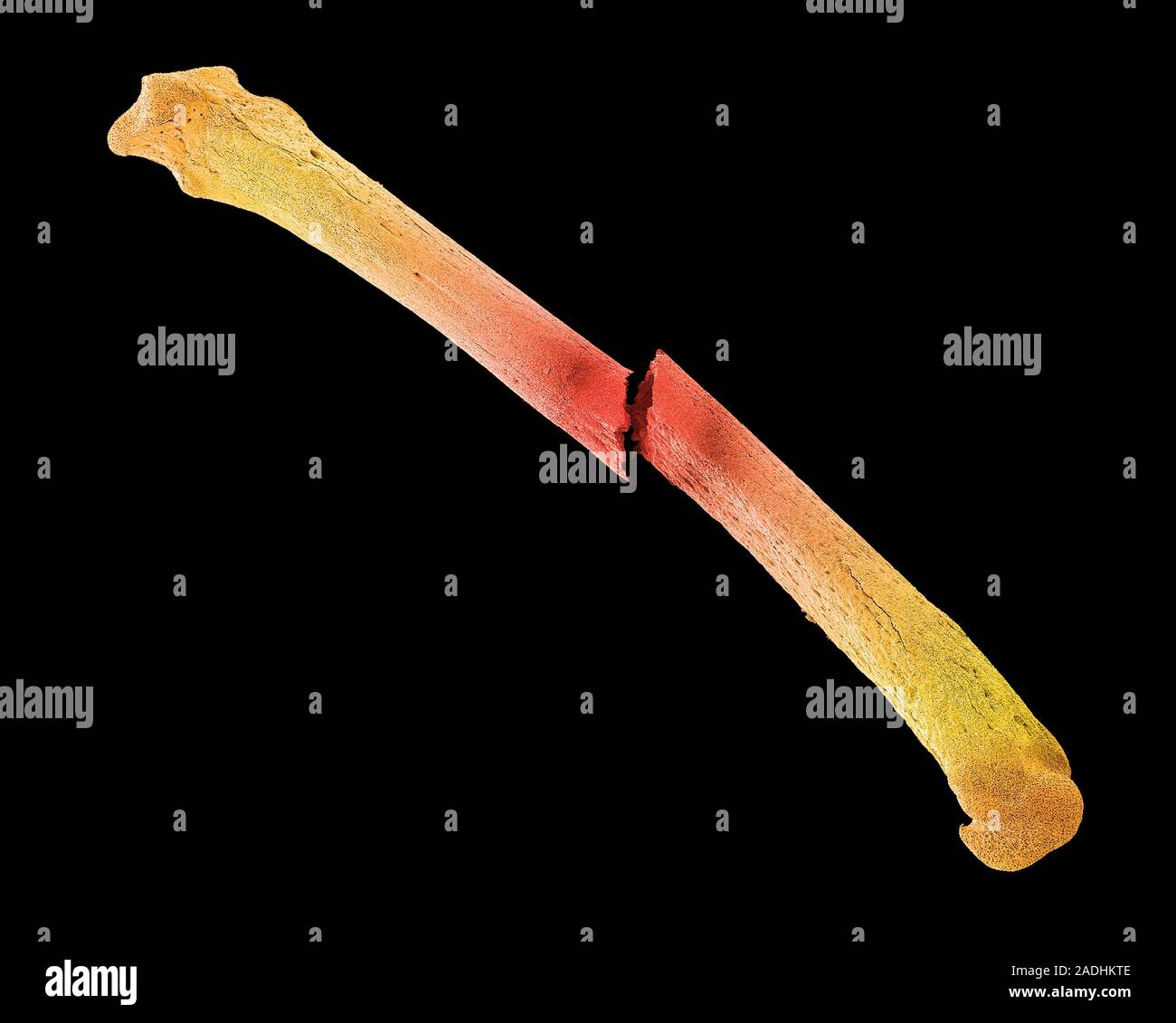 Osteoporotic bone. Coloured scanning electron micrograph (SEM) of a ...