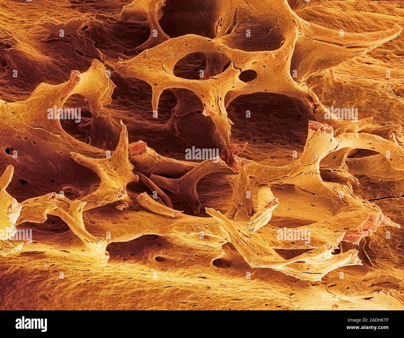 Osteoporotic spongy bone. Coloured scanning electron micrograph (SEM ...