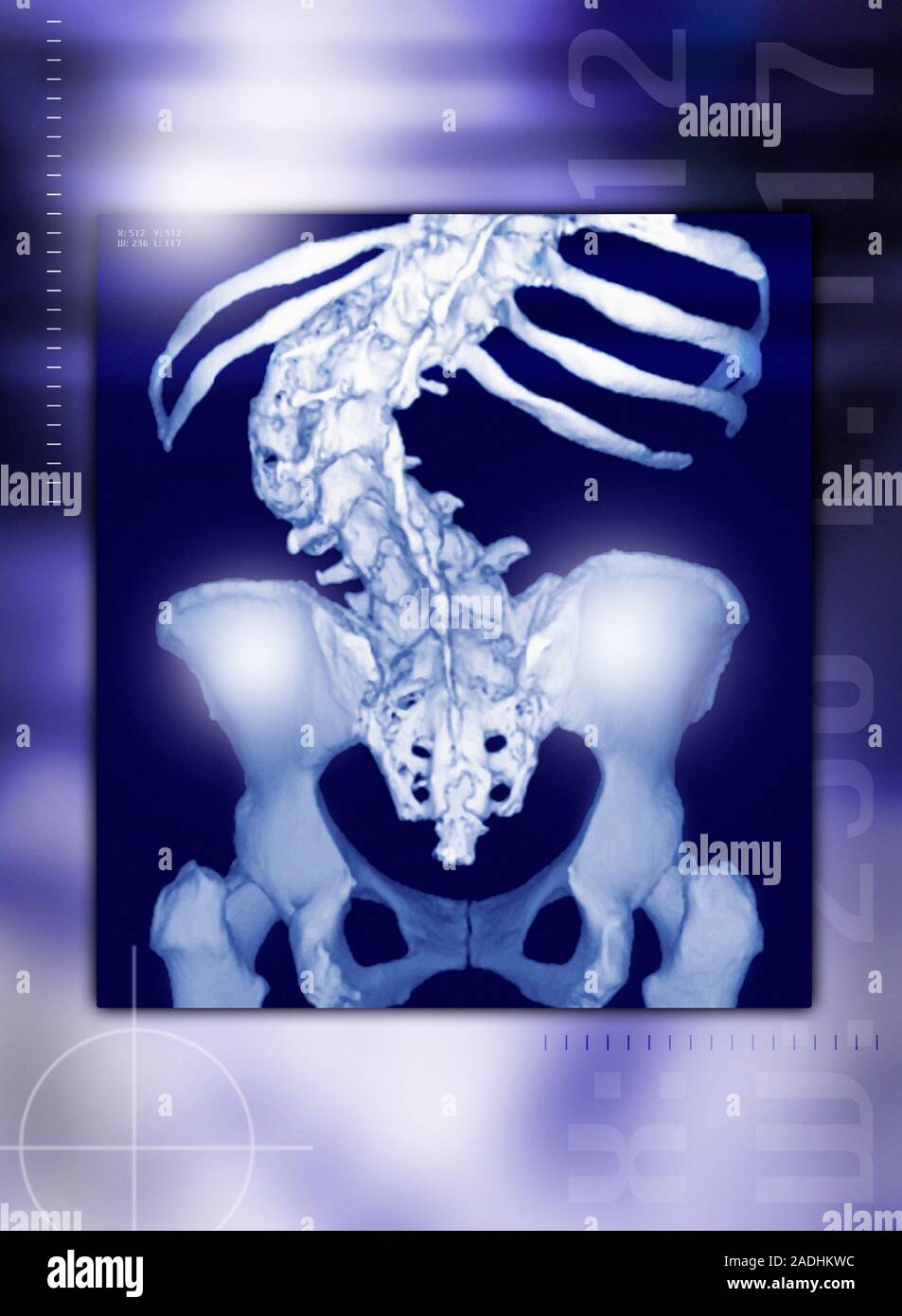 Osteoporosis of the spine. Coloured 3D computed tomography (CT) scan of ...
