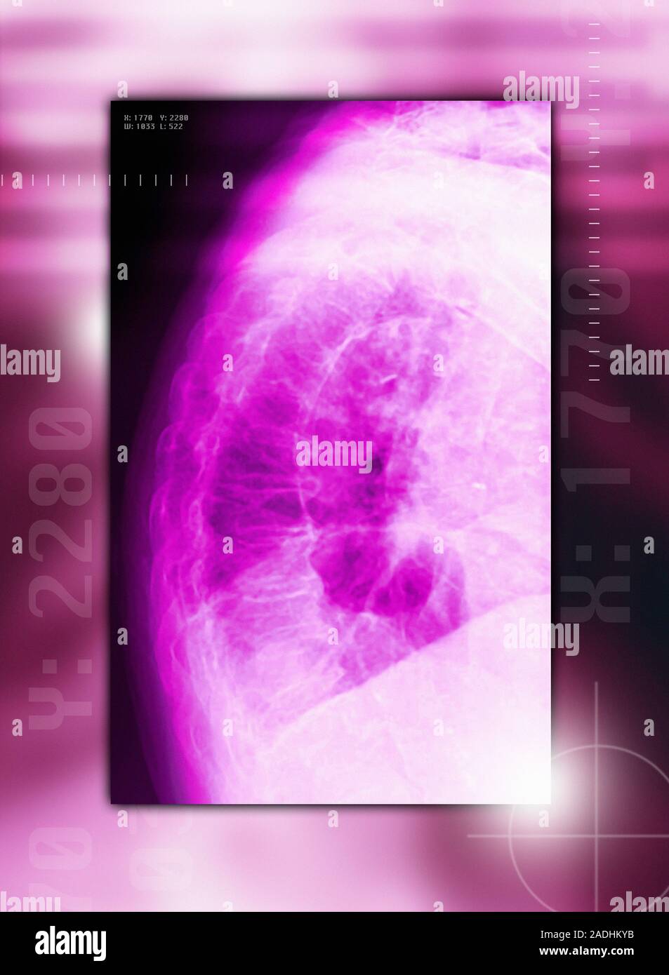 Osteoporotic spine, coloured X-ray. The spine is seen in side view ...
