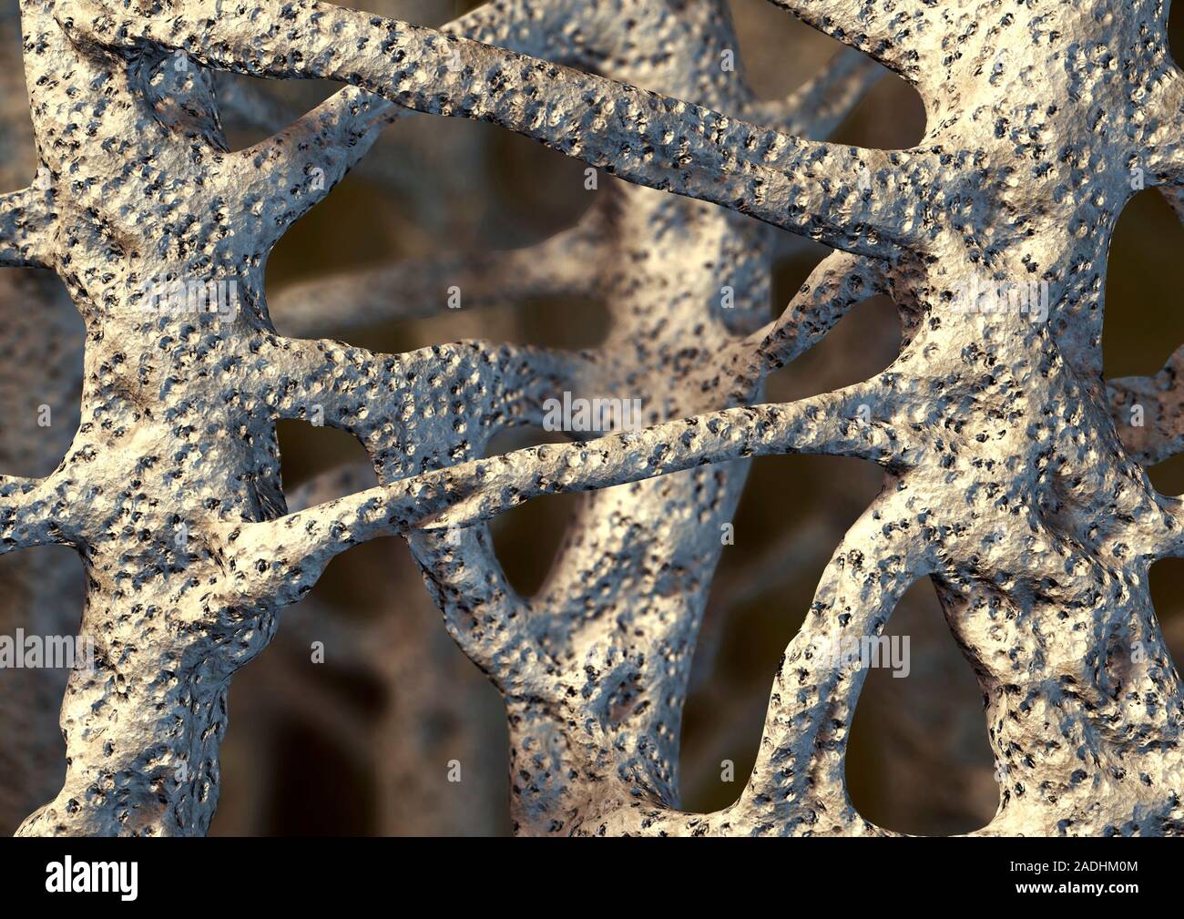 Osteoporosis. Computer artwork of osteoporotic bone. Osteoporosis ...