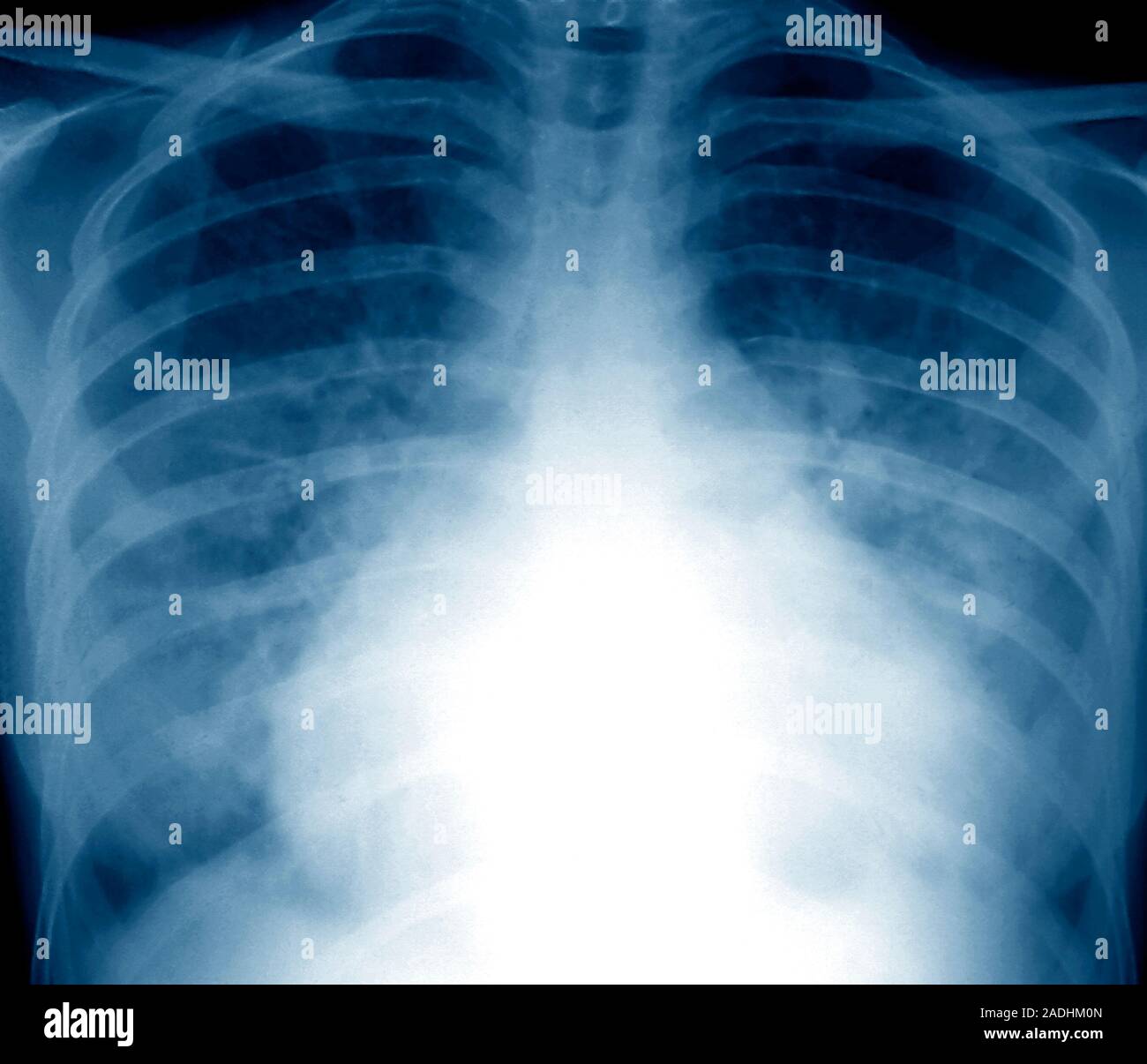 Flash pulmonary oedema. Coloured chest X-ray of a patient with flash ...