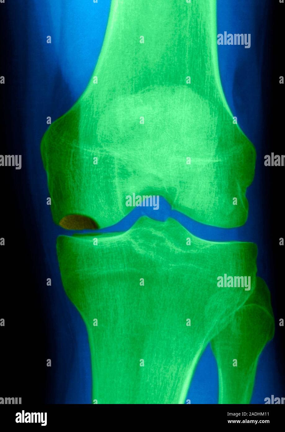 Bone death. Coloured X-ray of a frontal view of the knee of a 78 year ...