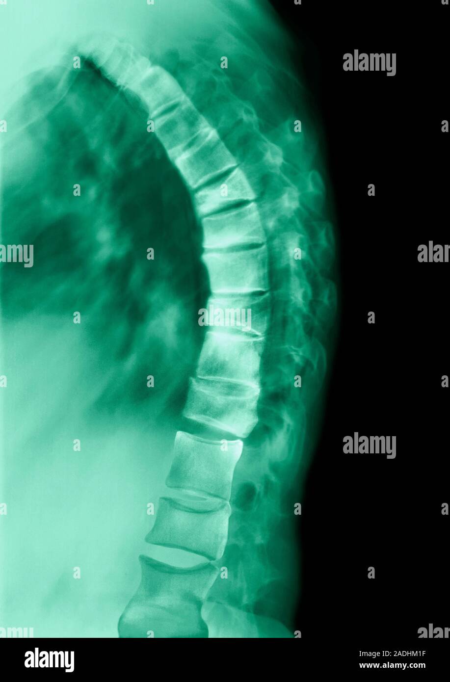 Osteoporosis of the back, coloured X-ray. Osteoporosis is a condition ...