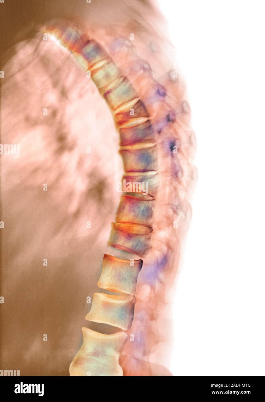 Osteoporosis of the back, coloured X-ray. Osteoporosis is a condition ...