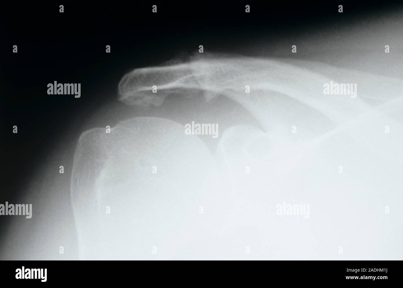 Disintegrating bone. X-ray of a clavicle (collar bone) showing signs of ...