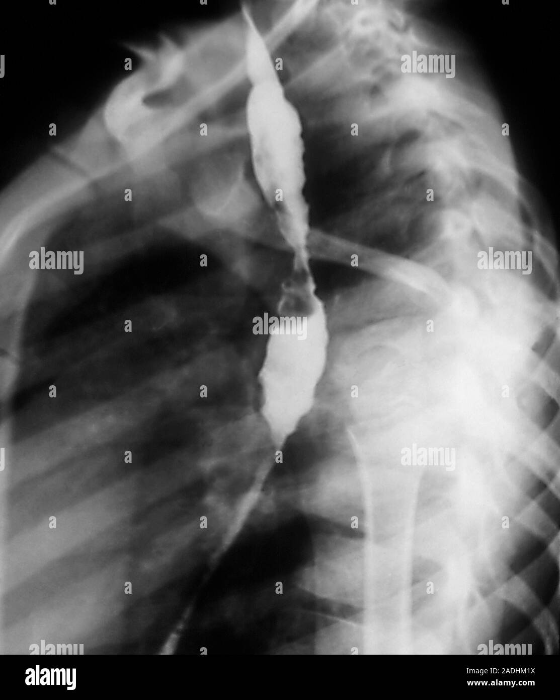 Oesophageal stricture, X-ray. Profile view of the chest of a patient ...