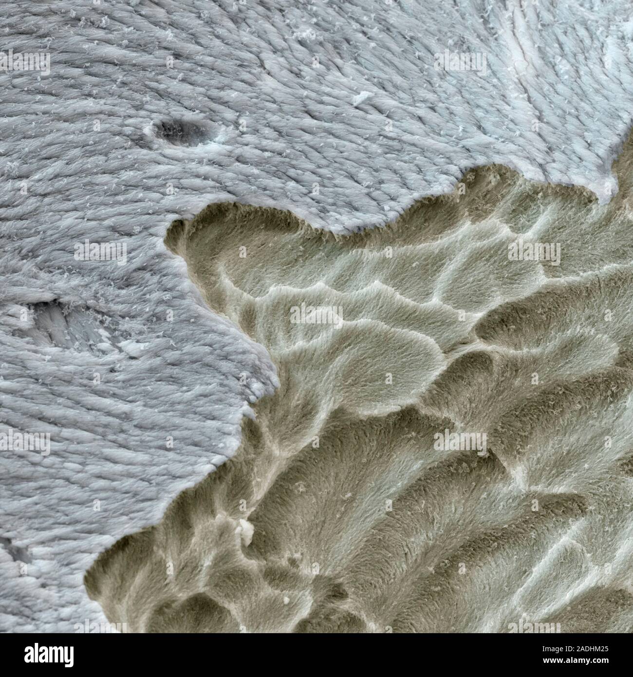 Osteoporotic bone, coloured scanning electron micrograph (SEM). Here ...