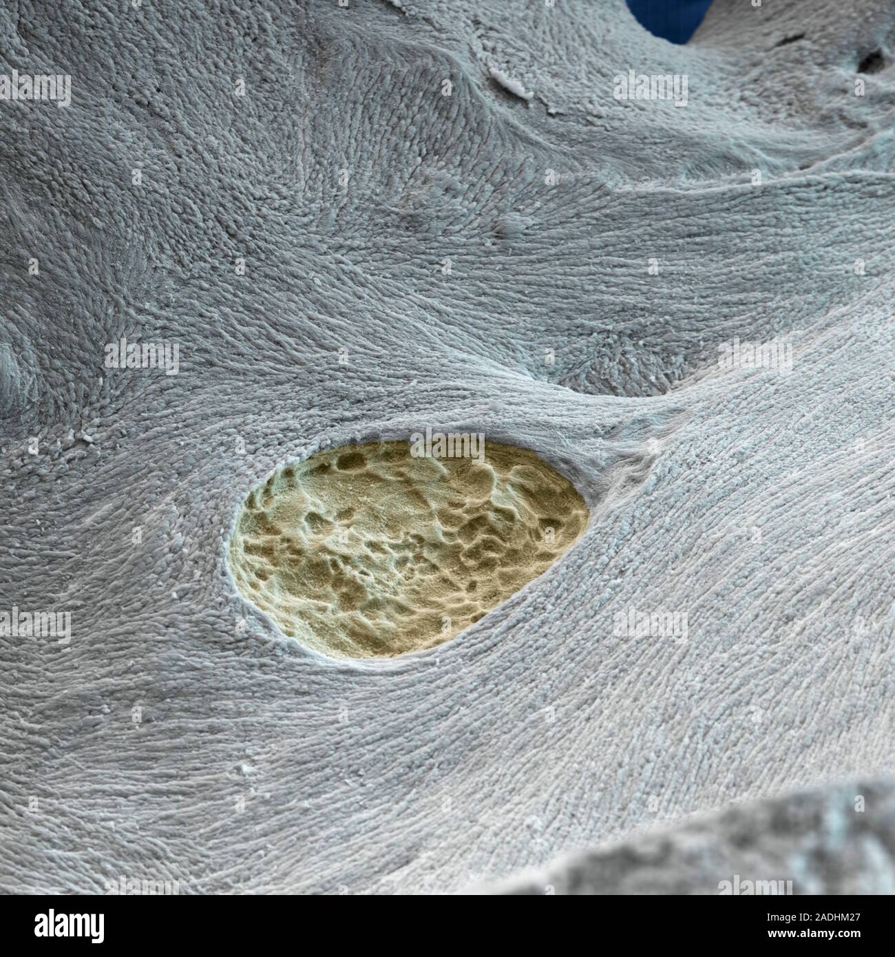 Osteoporotic bone, coloured scanning electron micrograph (SEM). Here ...