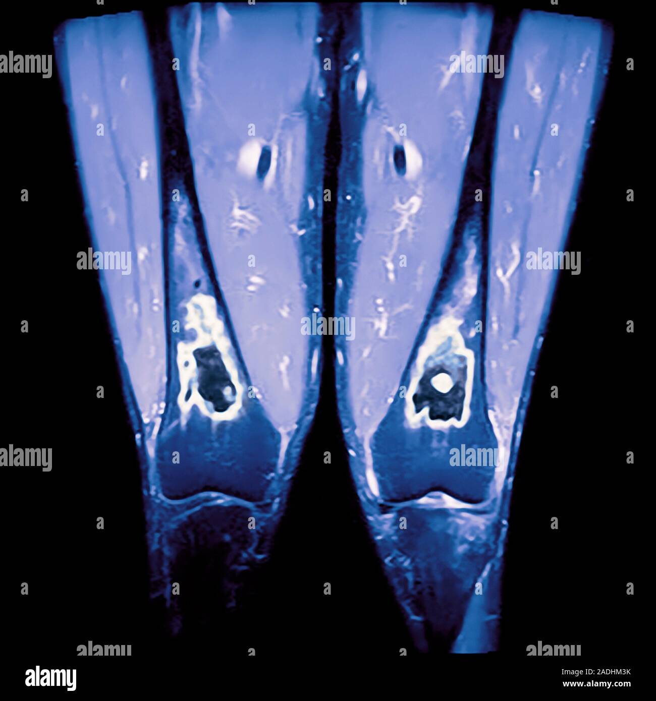 Bone death. Coloured frontal magnetic resonance imaging (MRI) scan of a ...