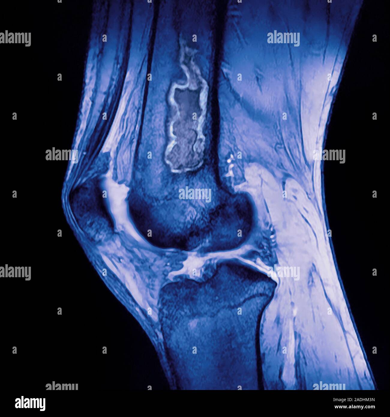 Bone death. Coloured magnetic resonance imaging (MRI) scan of the ...