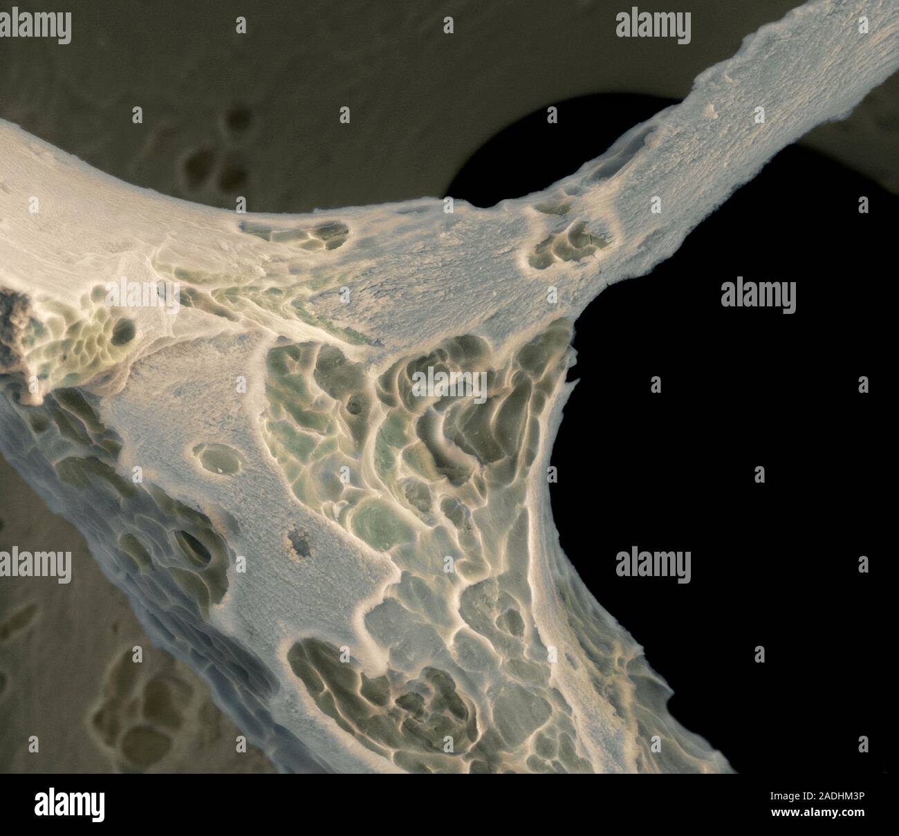 Osteoporosis. Coloured scanning electron micrograph (SEM) of an ...