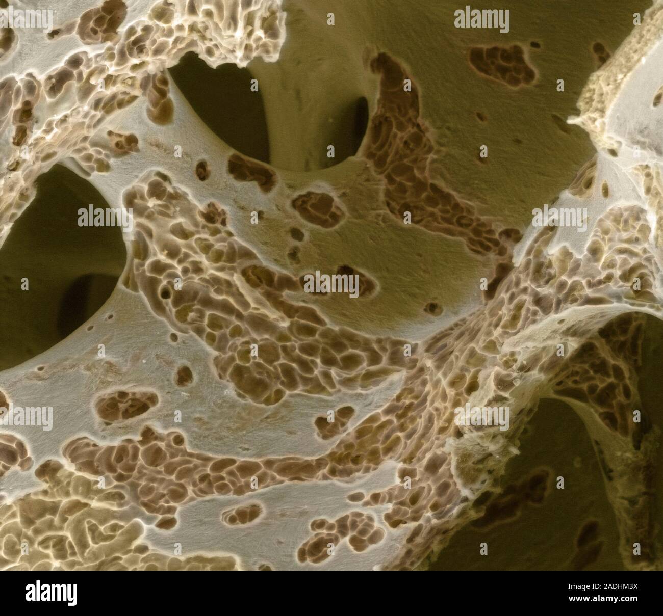 Osteoporosis. Coloured scanning electron micrograph (SEM) of an ...