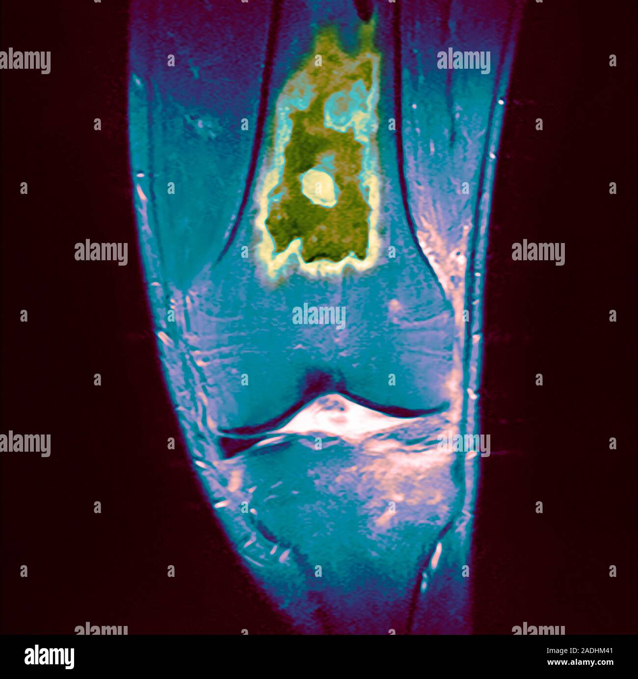 Bone death. Coloured frontal magnetic resonance imaging (MRI) scan of ...