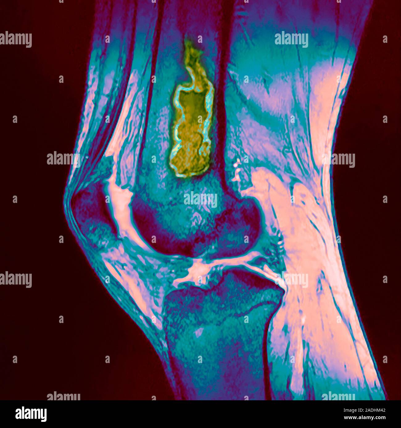 Bone death. Coloured magnetic resonance imaging (MRI) scan of the ...