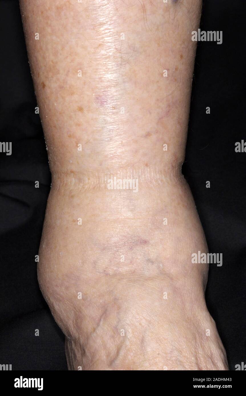 Oedema. Swollen ankle of an 80 year old woman suffering from oedema ...