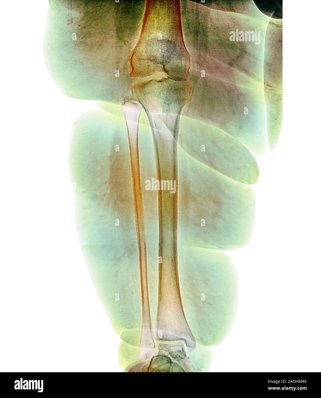Obese person's lower leg, coloured X-ray. At top centre is the femur ...
