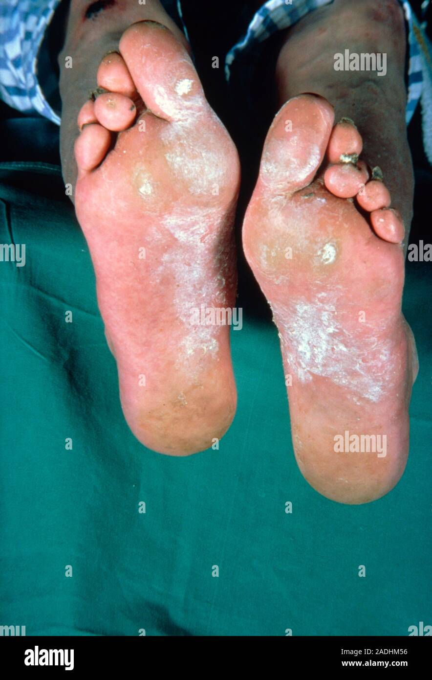 Scaly dermatitis affecting the soles of the feet of a person suffering ...