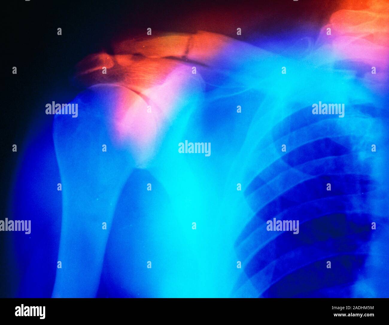 False-colour X-ray showing a fractured clavicle (collar bone) caused by ...