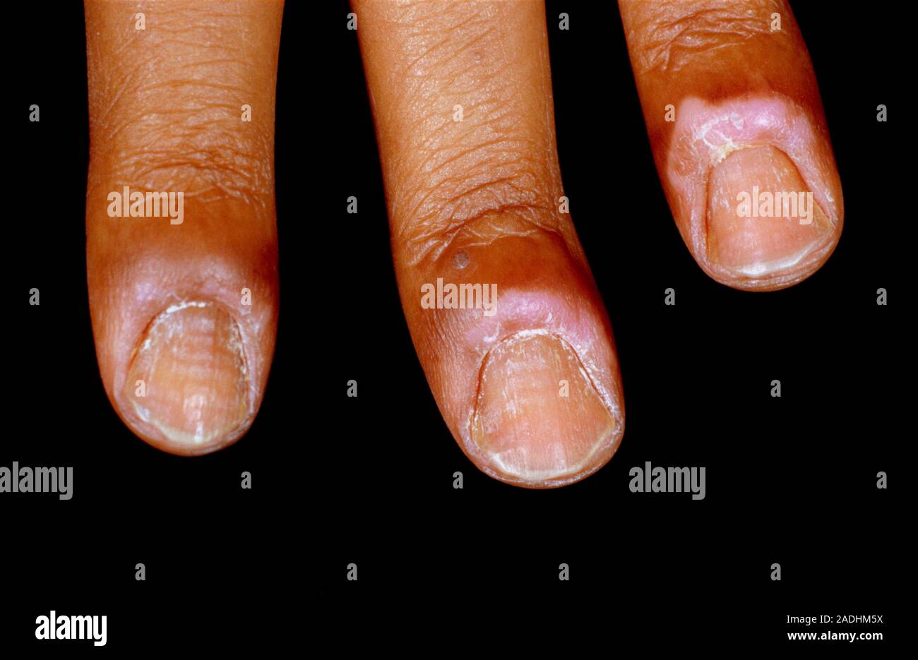 Photograph of the fingers of a patient suffering from chronic ...