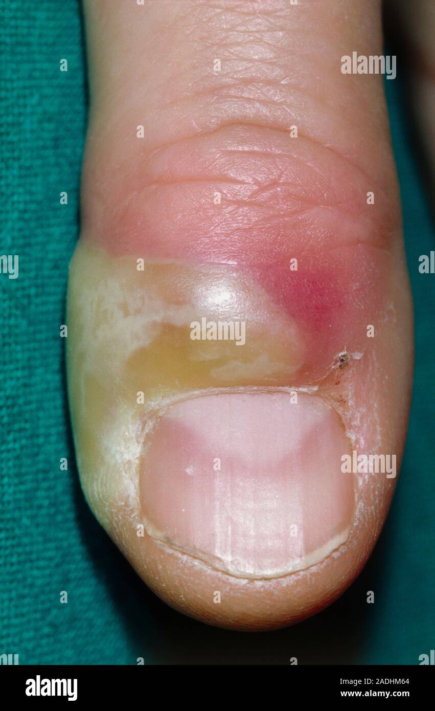 Acute paronychia, an acute inflammation & swelling in the tissues ...
