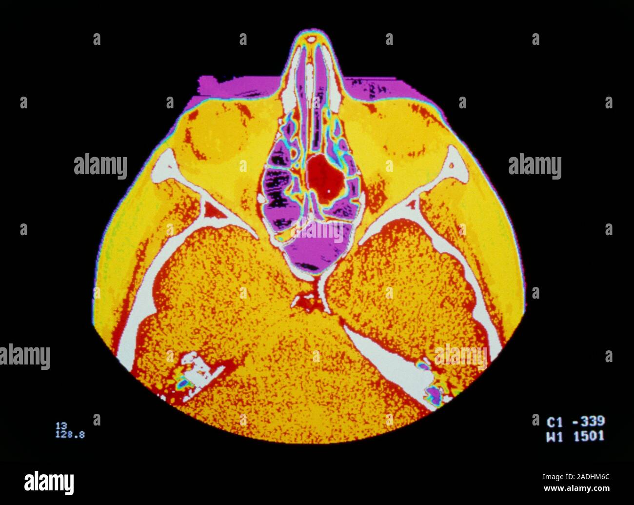 False-colour computed tomography (CT) scan of an axial section through ...