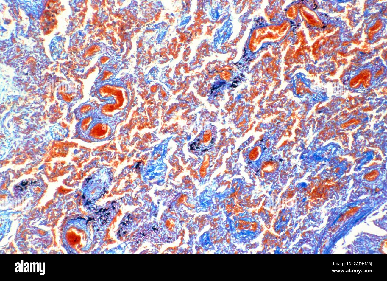 Chronic pneumonia of the lung. Light micrograph of a section of lung ...