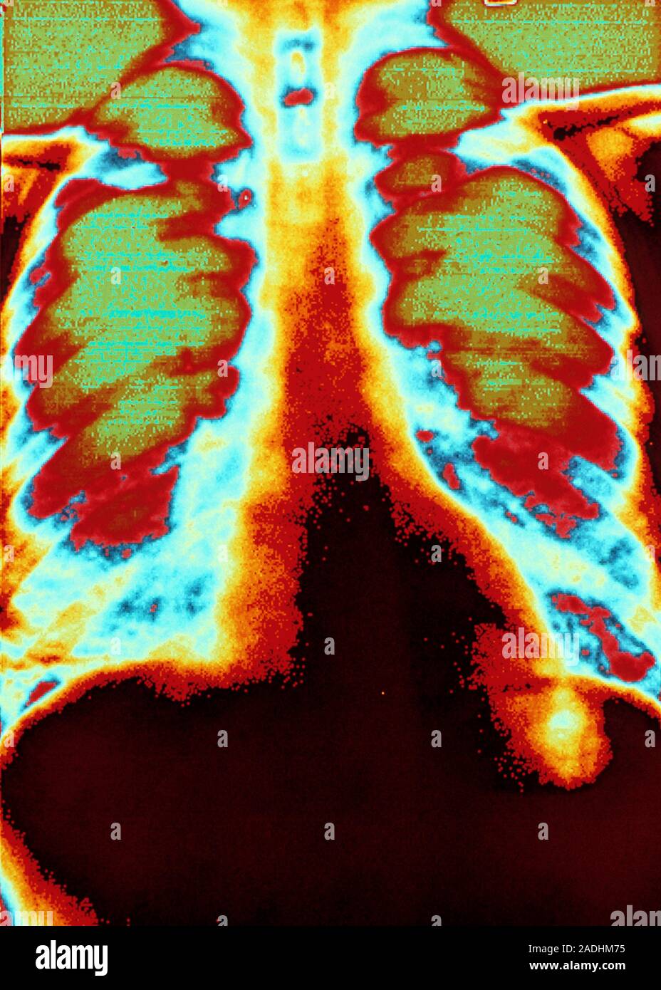 Pneumonia. Digitised coloured X-ray of a patient's chest, showing lungs ...