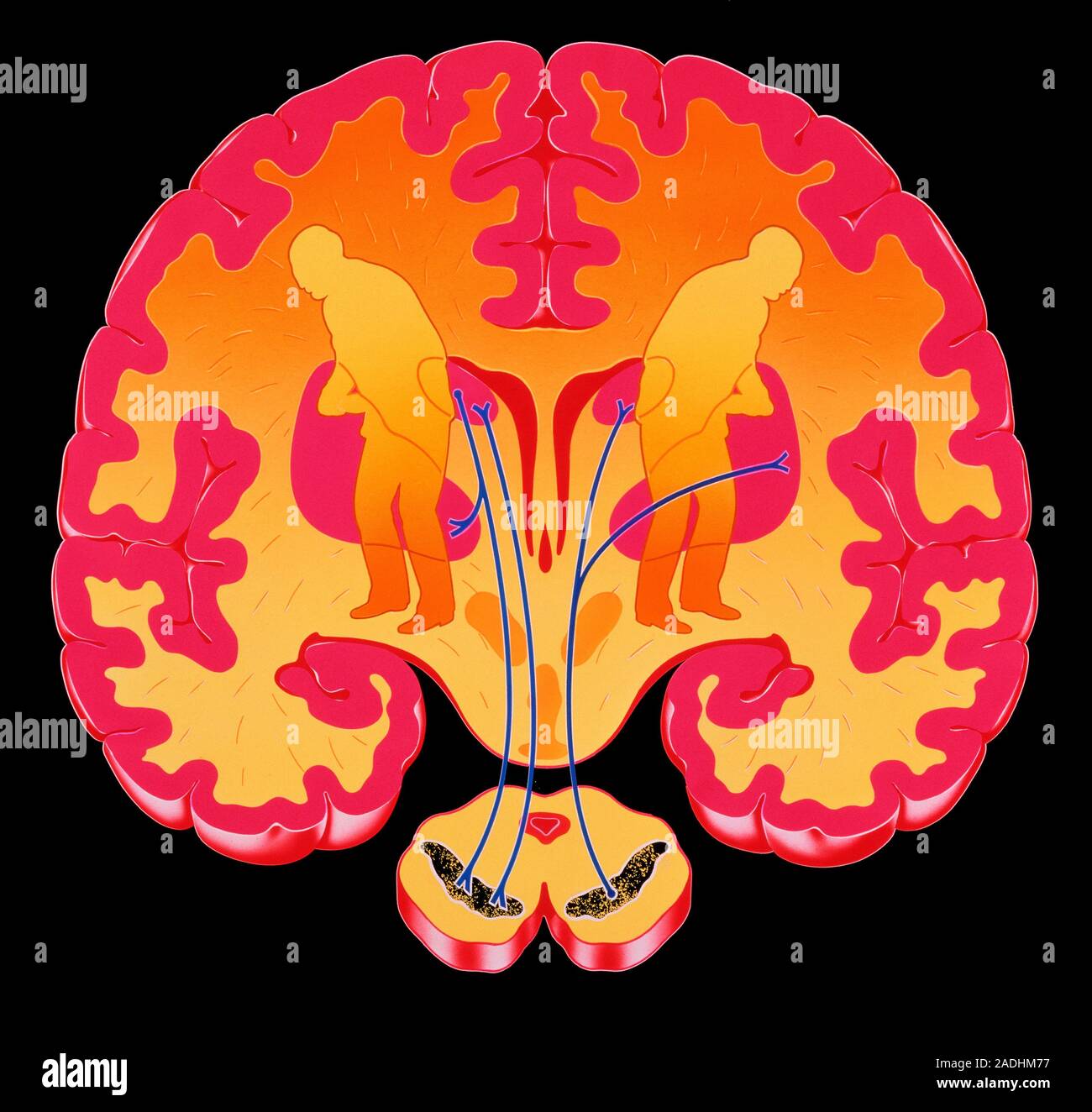 Parkinson's disease. Illustration of the brain, depicting the ...
